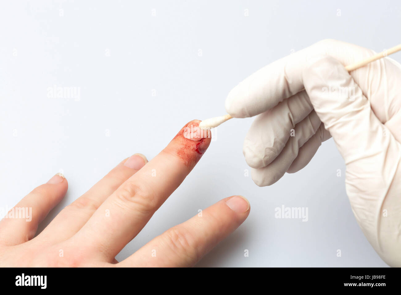 Wound cleaning hand hi-res stock photography and images - Alamy
