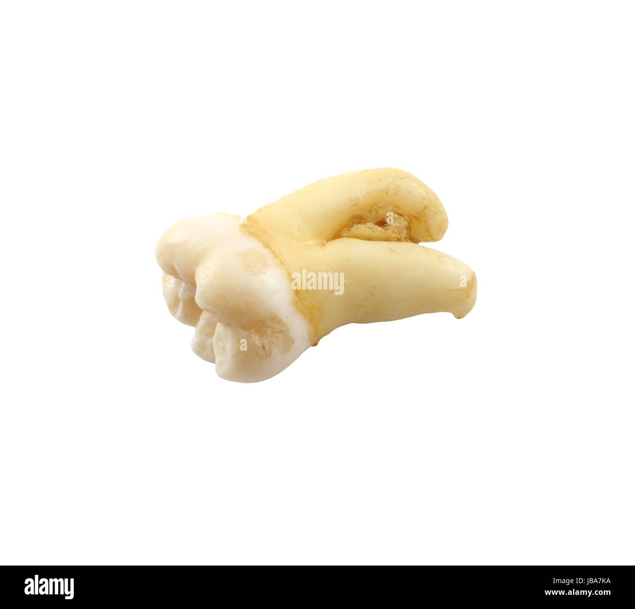 Wisdom tooth hi-res stock photography and images - Alamy
