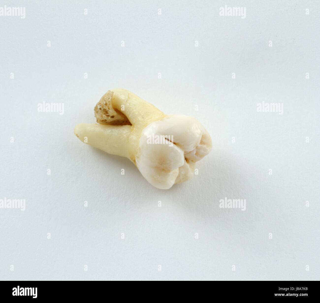 Wisdom tooth extraction hi-res stock photography and images - Alamy