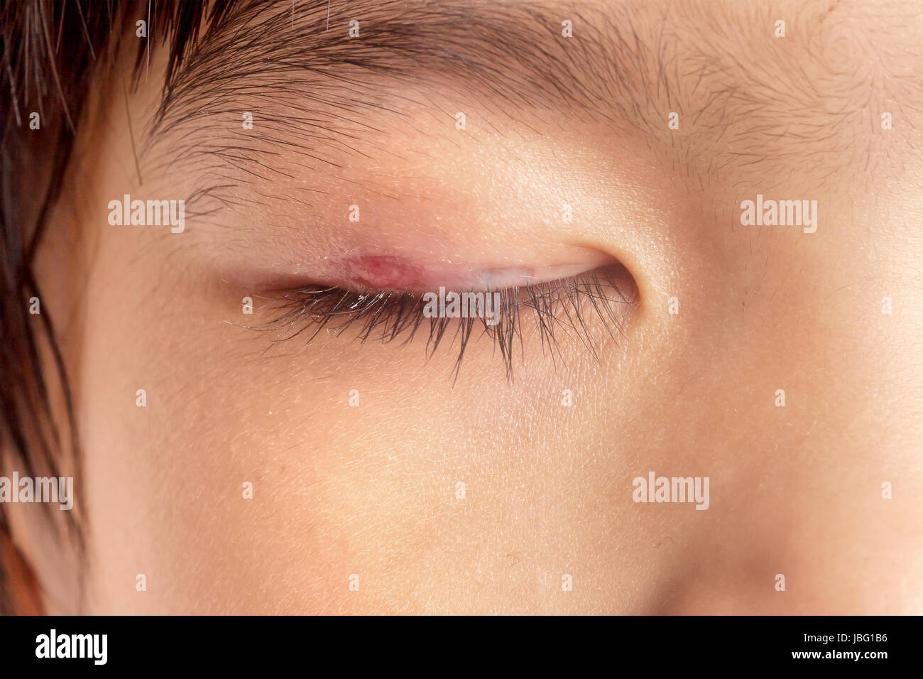 Meibomian gland hi-res stock photography and images - Alamy