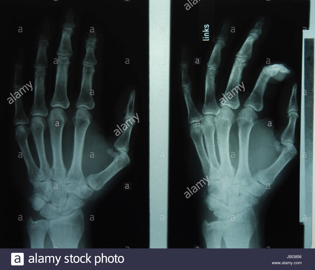 Rontgenbild High Resolution Stock Photography and Images - Alamy