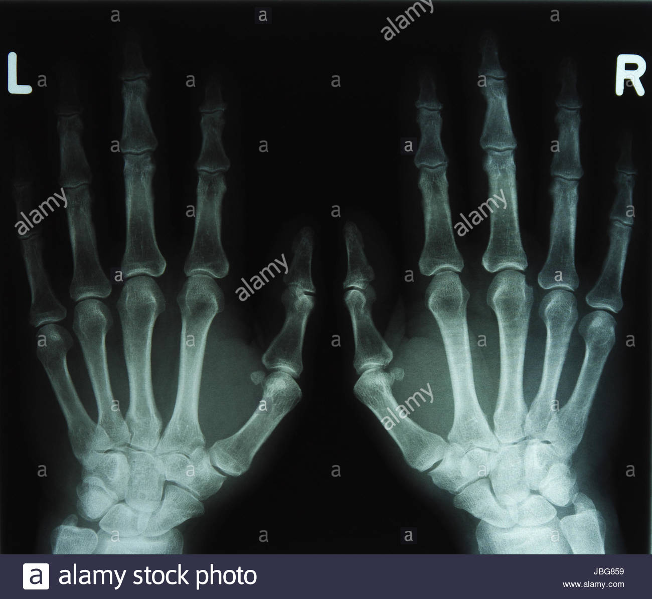 Rontgen Hand High Resolution Stock Photography and Images - Alamy