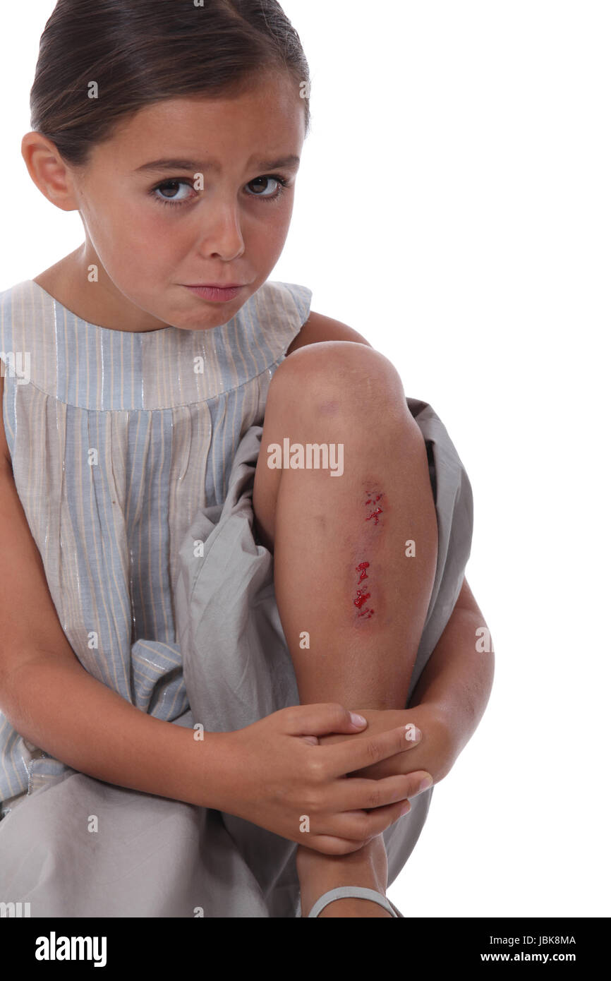 a little girl with a wounded leg Stock Photo - Alamy