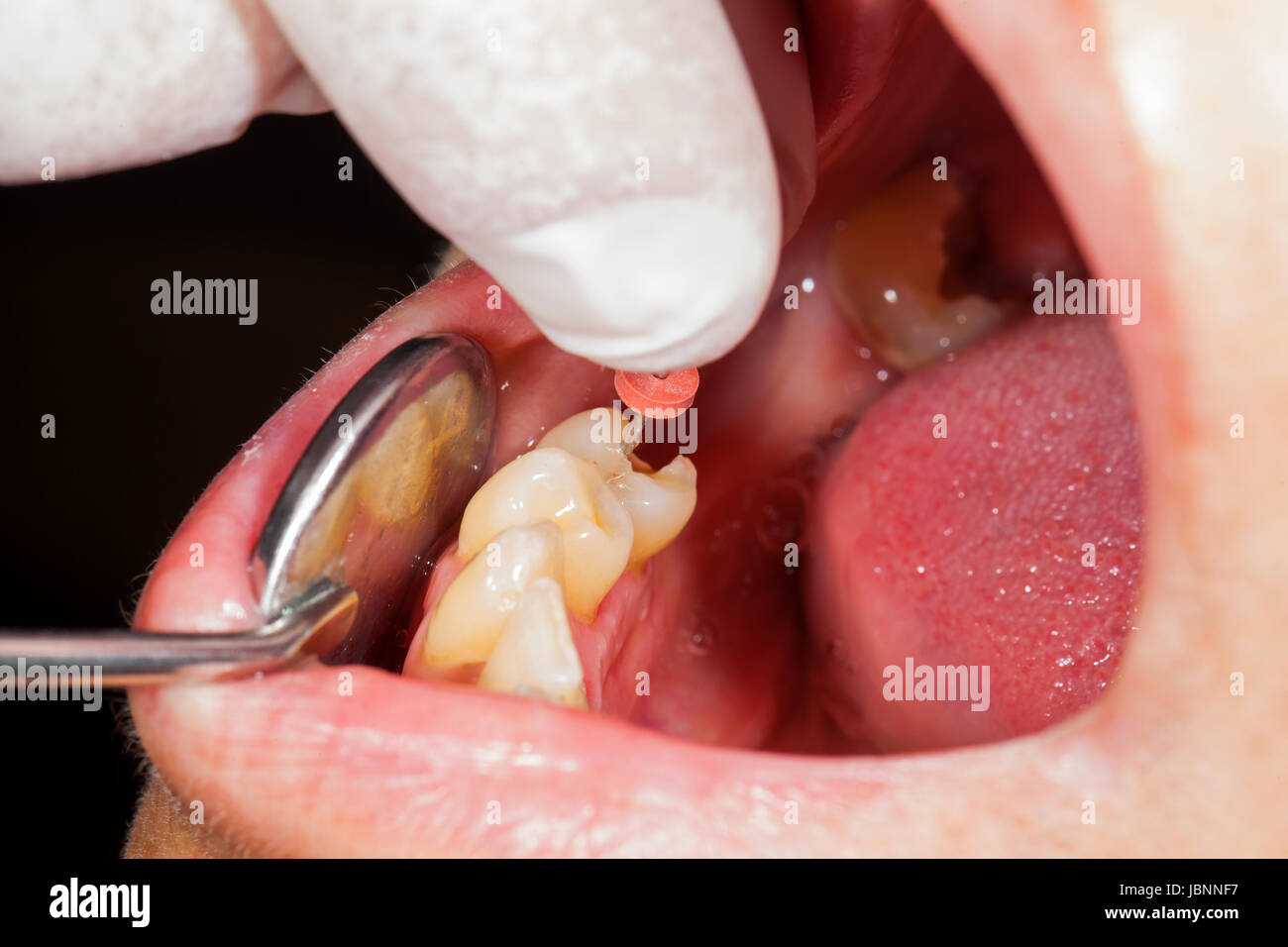 Close up picture of endodontic procedure on a human damaged tooth Stock ...