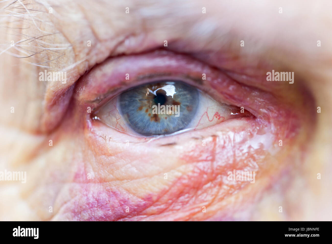 Close up picture of an elderly woman's injured eye & face - domestic ...