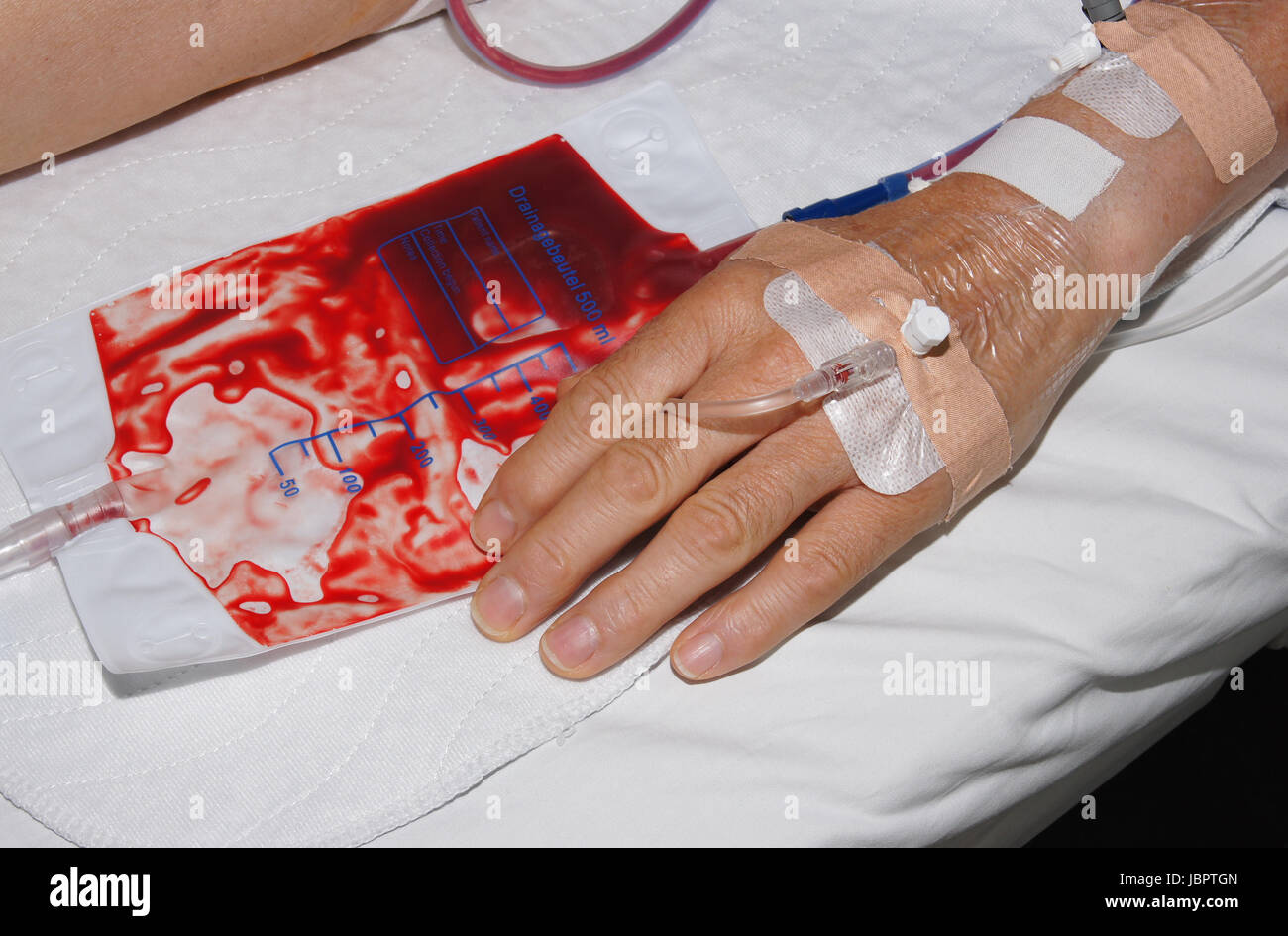 Blood infusion hi-res stock photography and images - Alamy