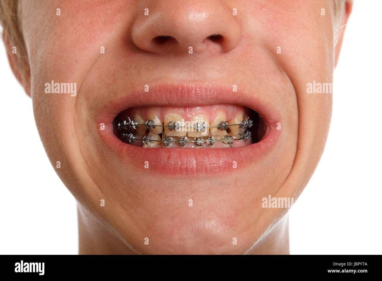 a set of teeth braces on boys teeth Stock Photo - Alamy
