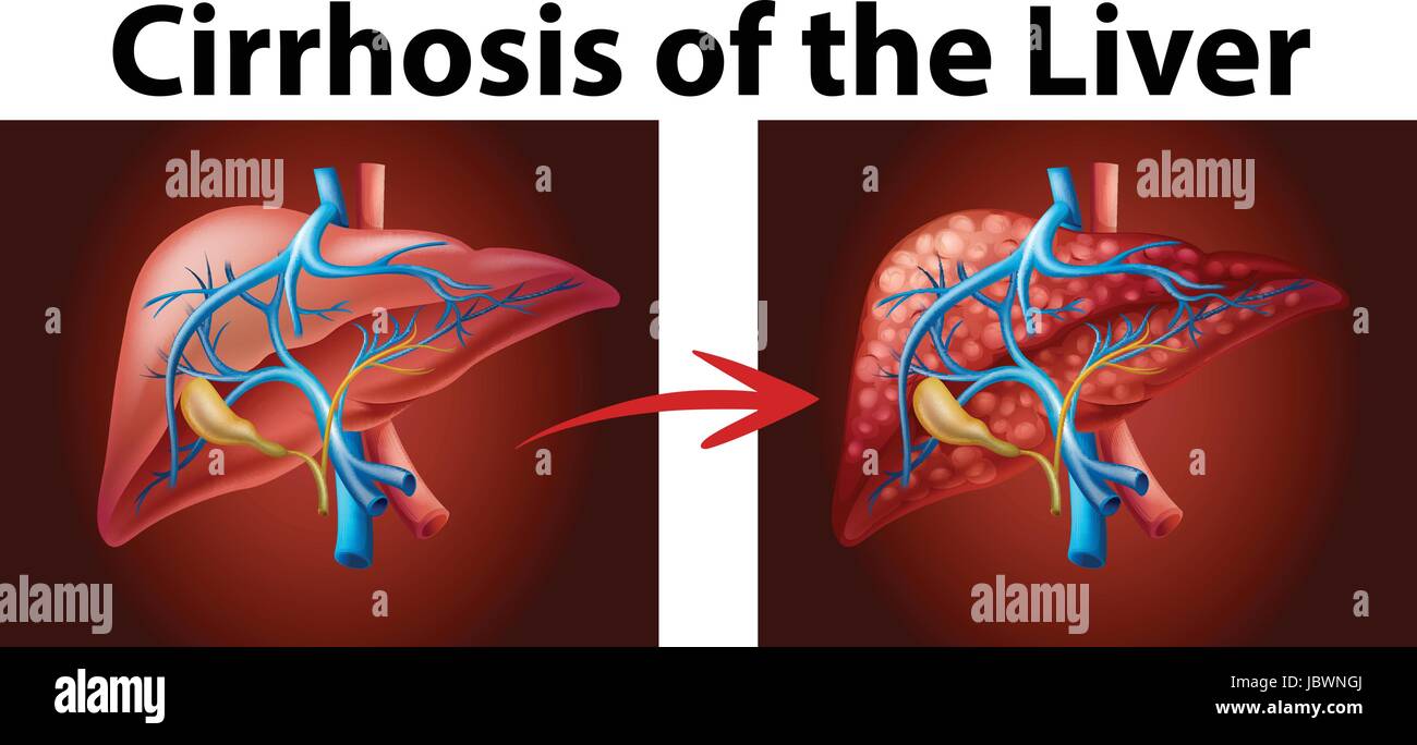 Diagram showing cirrhosis of the liver illustration Stock Vector Image ...