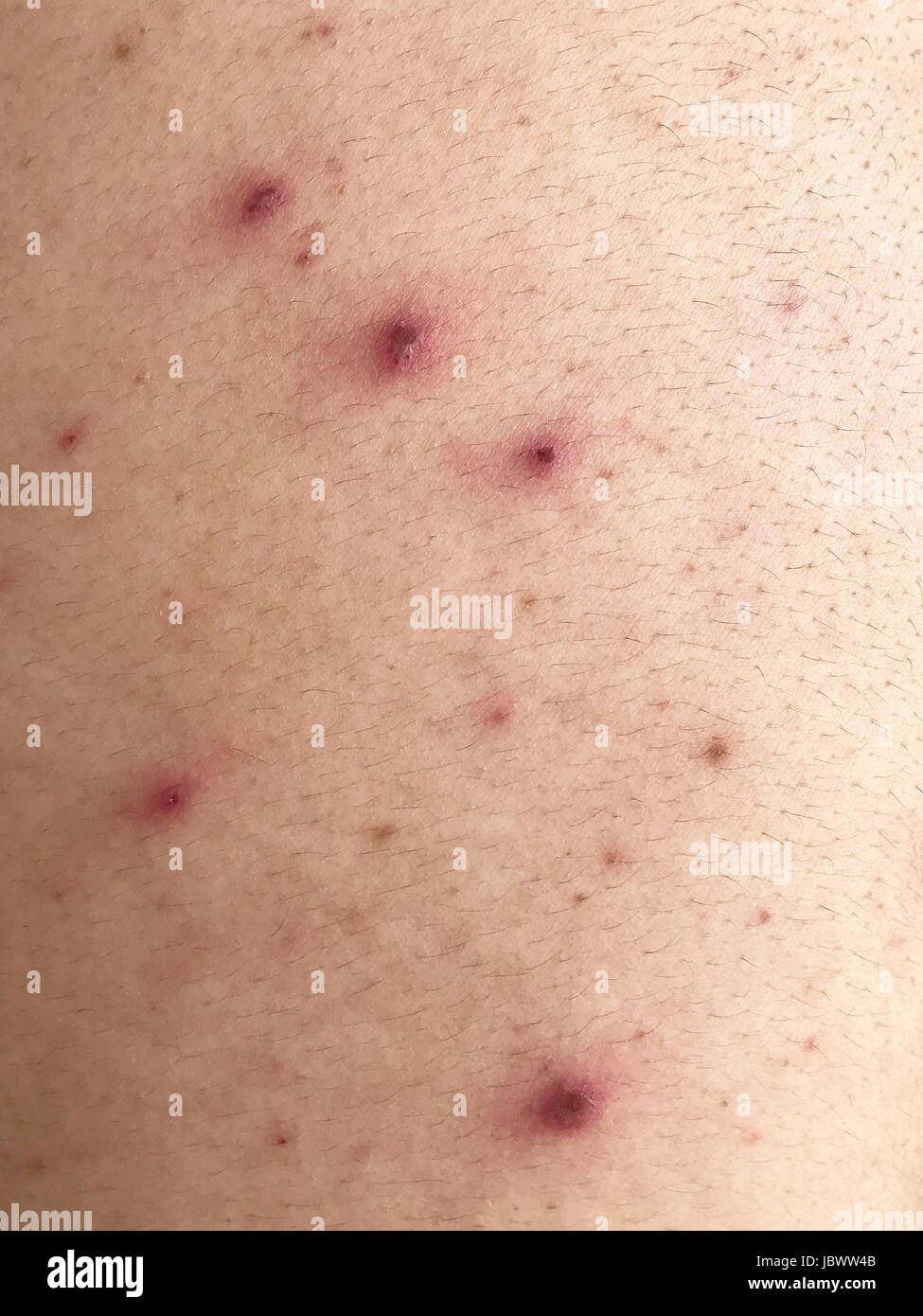 Chickenpox hi-res stock photography and images - Alamy