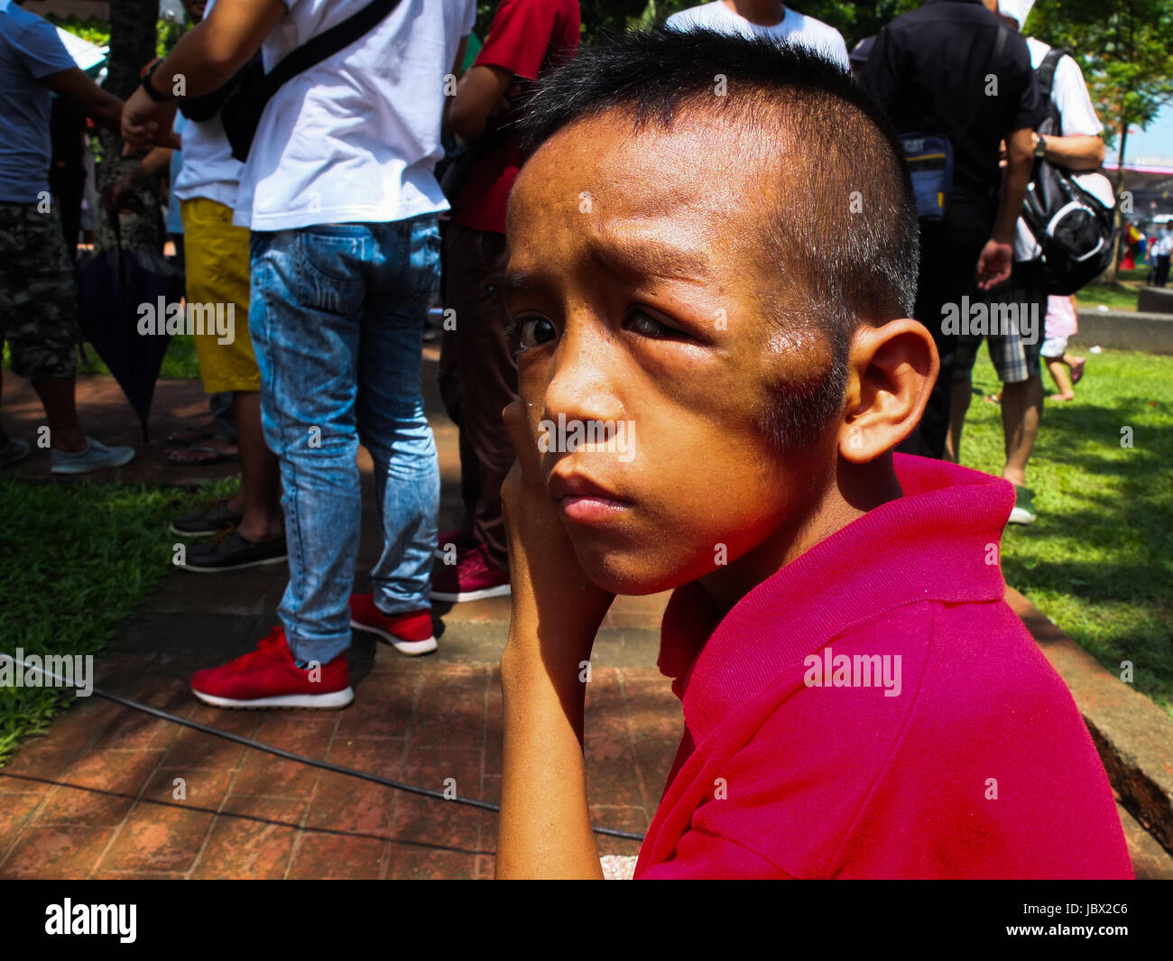 Edison Bulagui, a child with a huge lump on his face that affect his ...