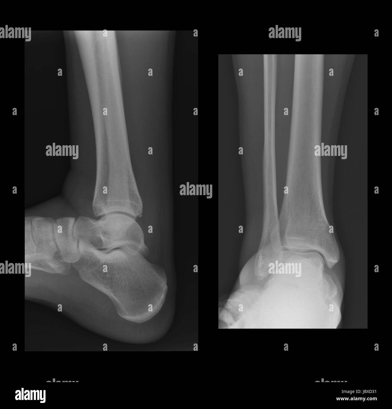 Two ankle radiographs showing inflammation and a little fracture Stock ...