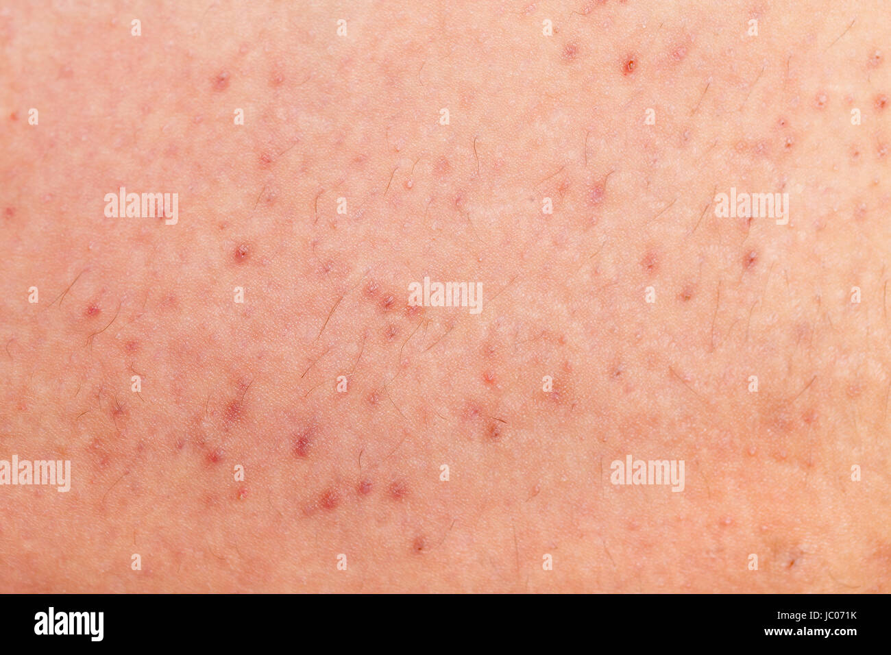 Close up picture of folliculitis on human skin Stock Photo - Alamy