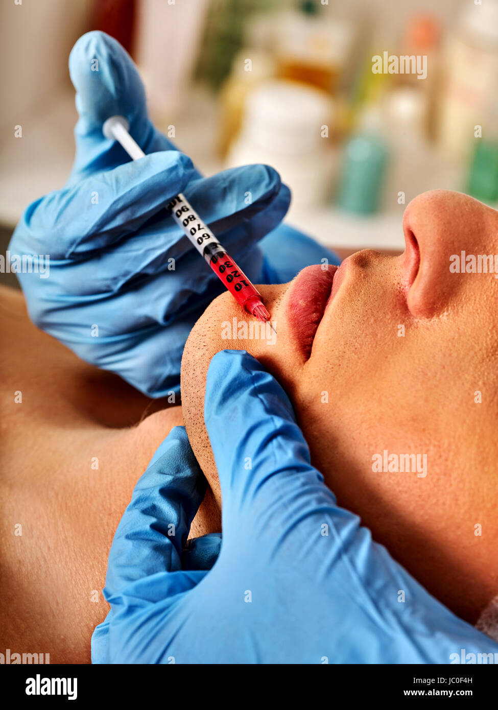 Filler injection for male forehead face. Plastic aesthetic facial ...