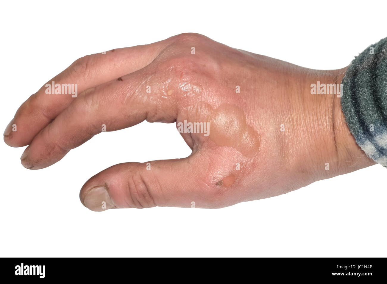 Burn Scar Hand Stock Photos & Burn Scar Hand Stock Images - Alamy
