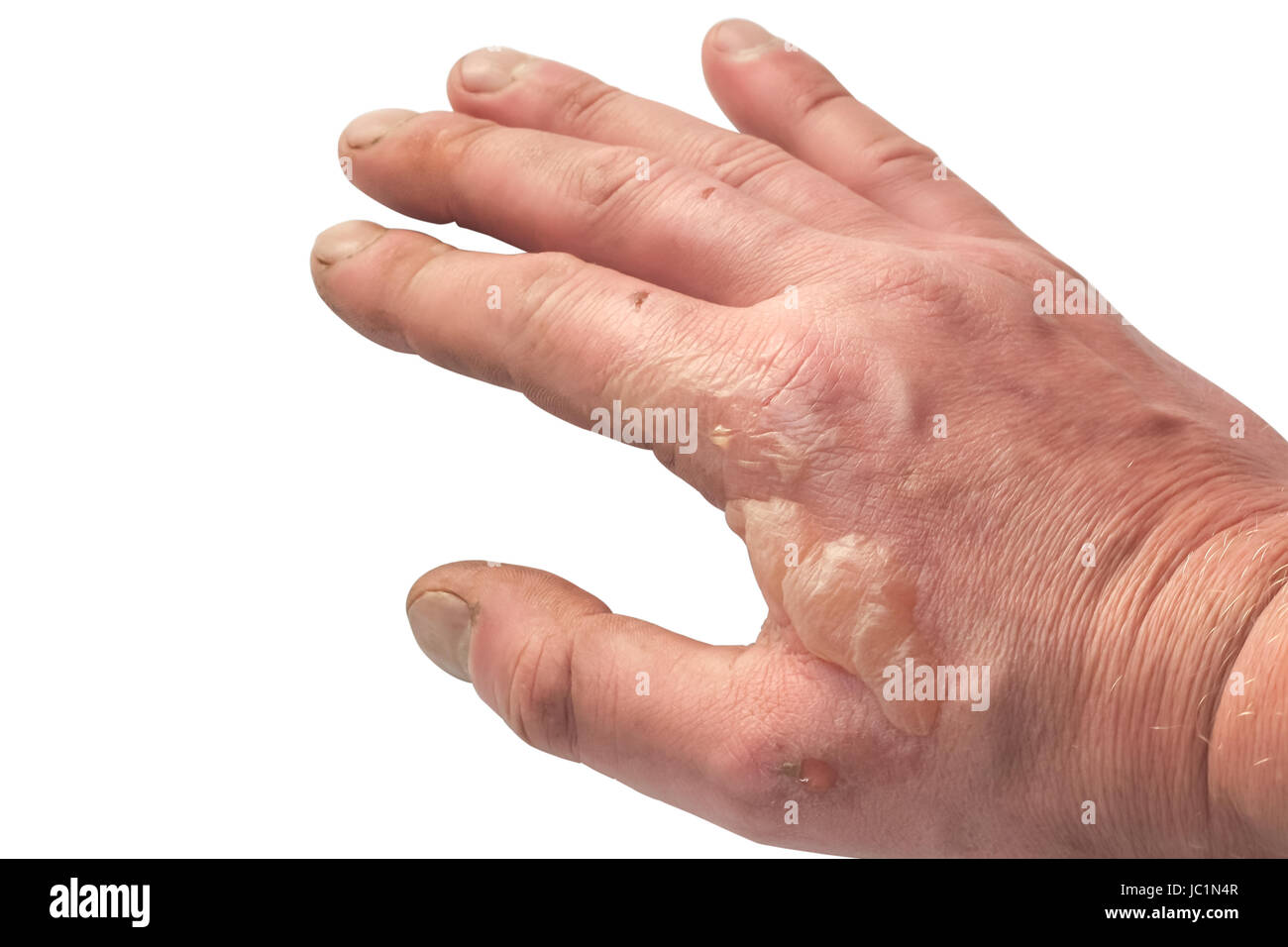 Burn Scar Hand Stock Photos & Burn Scar Hand Stock Images - Alamy