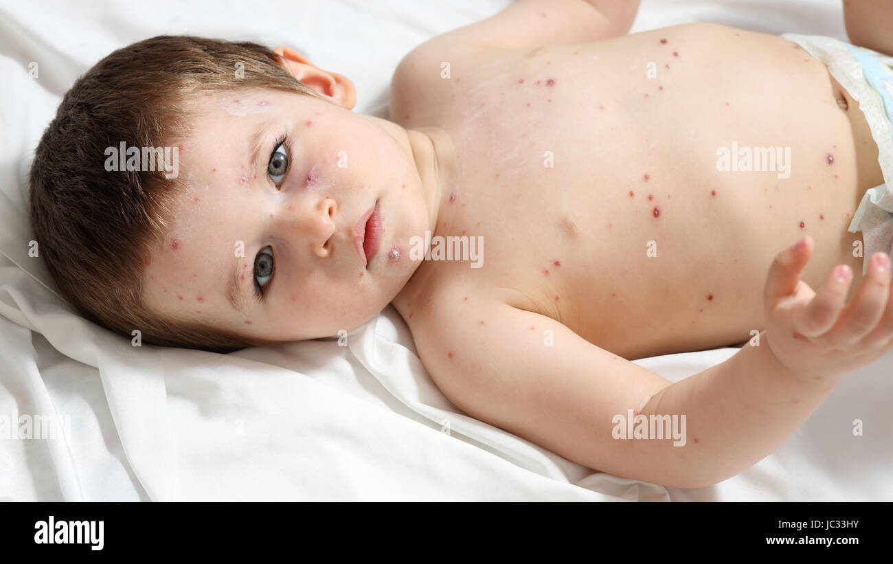 Details of a baby aged 20 months old, he has chickenpox Stock Photo - Alamy