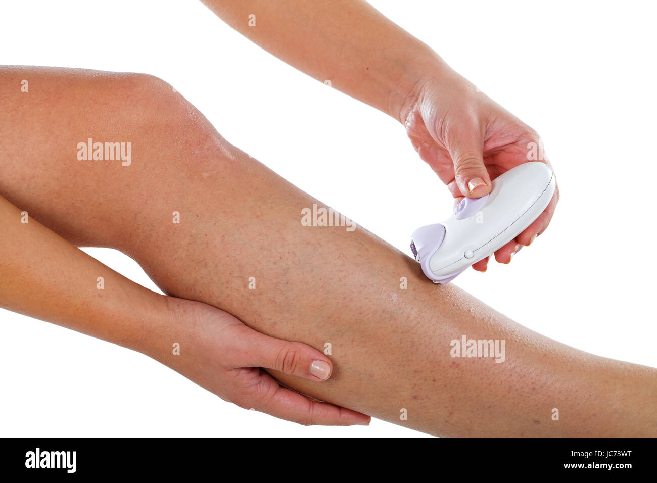 Picture of a young woman's leg having varicose veins and epilator on ...