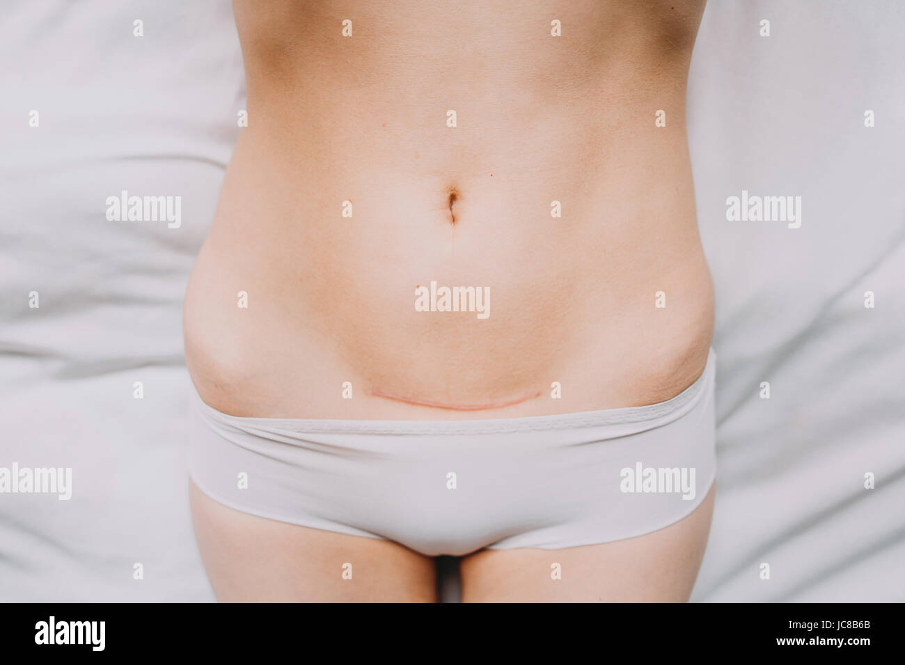 Cesarean section scar hi-res stock photography and images - Alamy