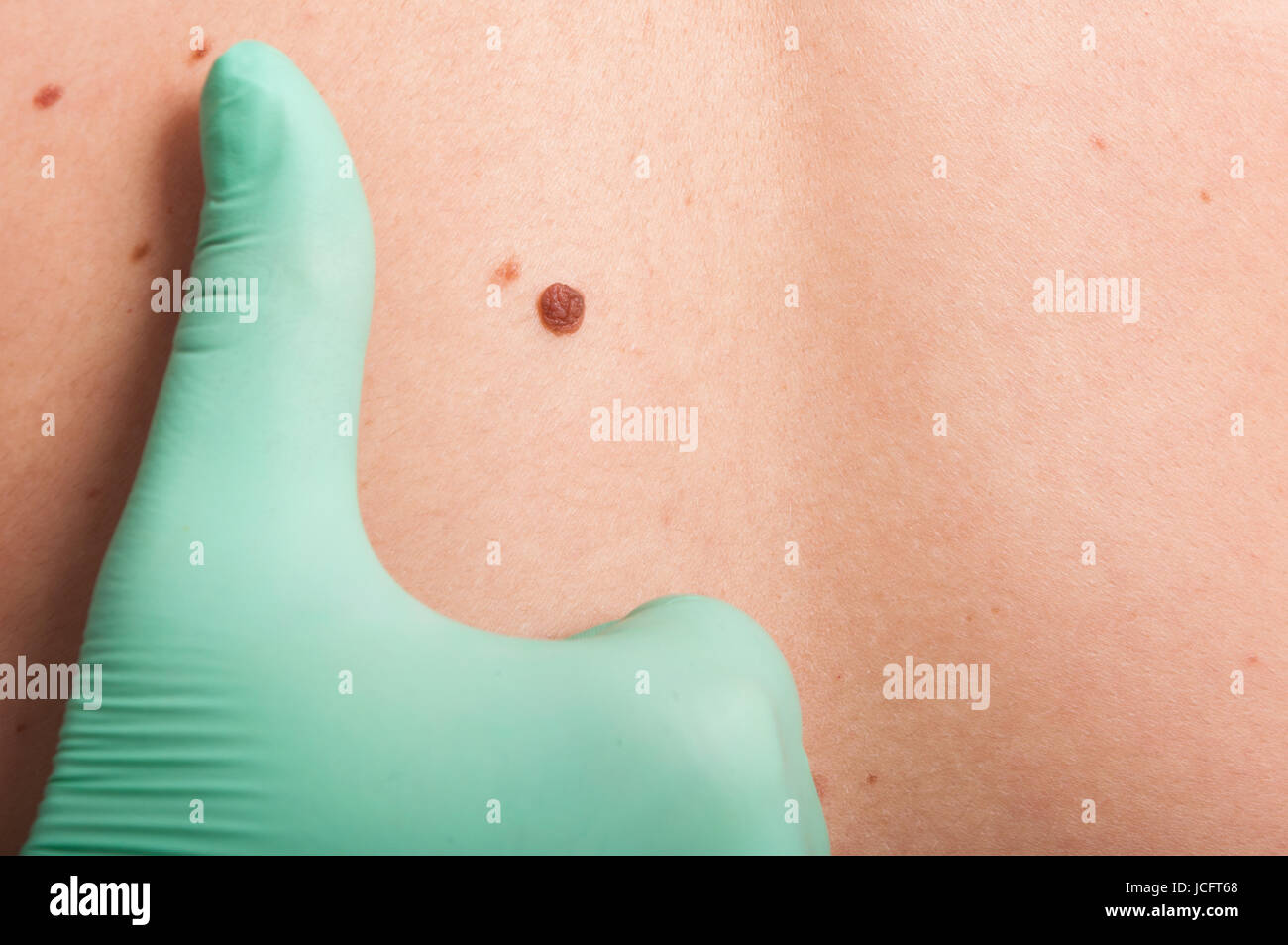 Doctor hand examining skin mole as dermatological problem and ...