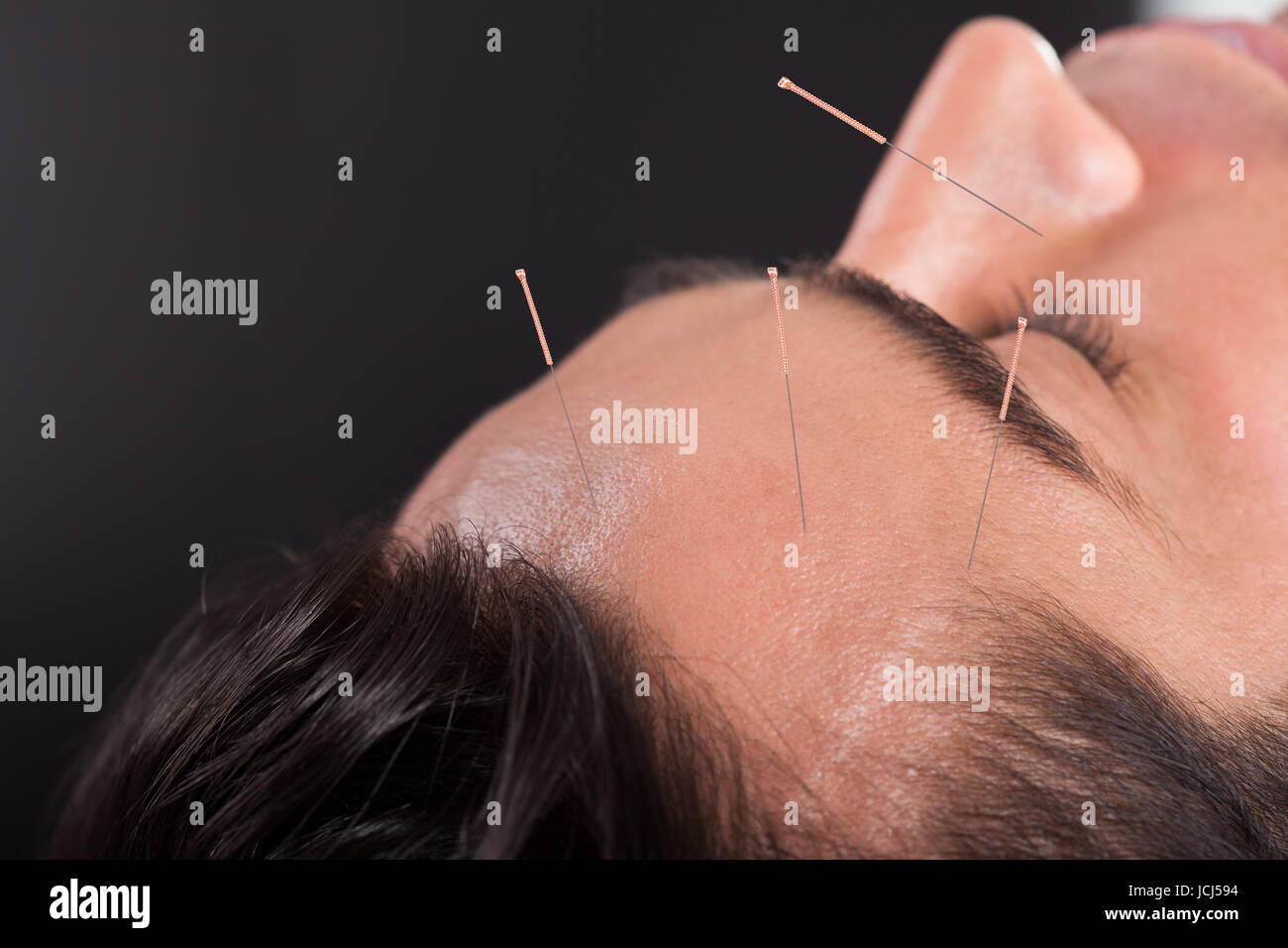 Male patient undergoing acupuncture hi-res stock photography and images ...