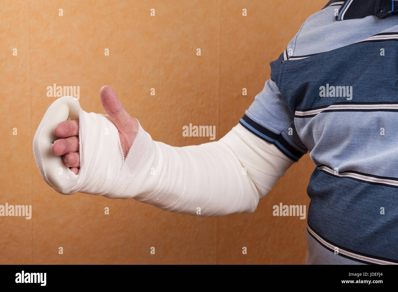 Arm in plaster Stock Photo - Alamy