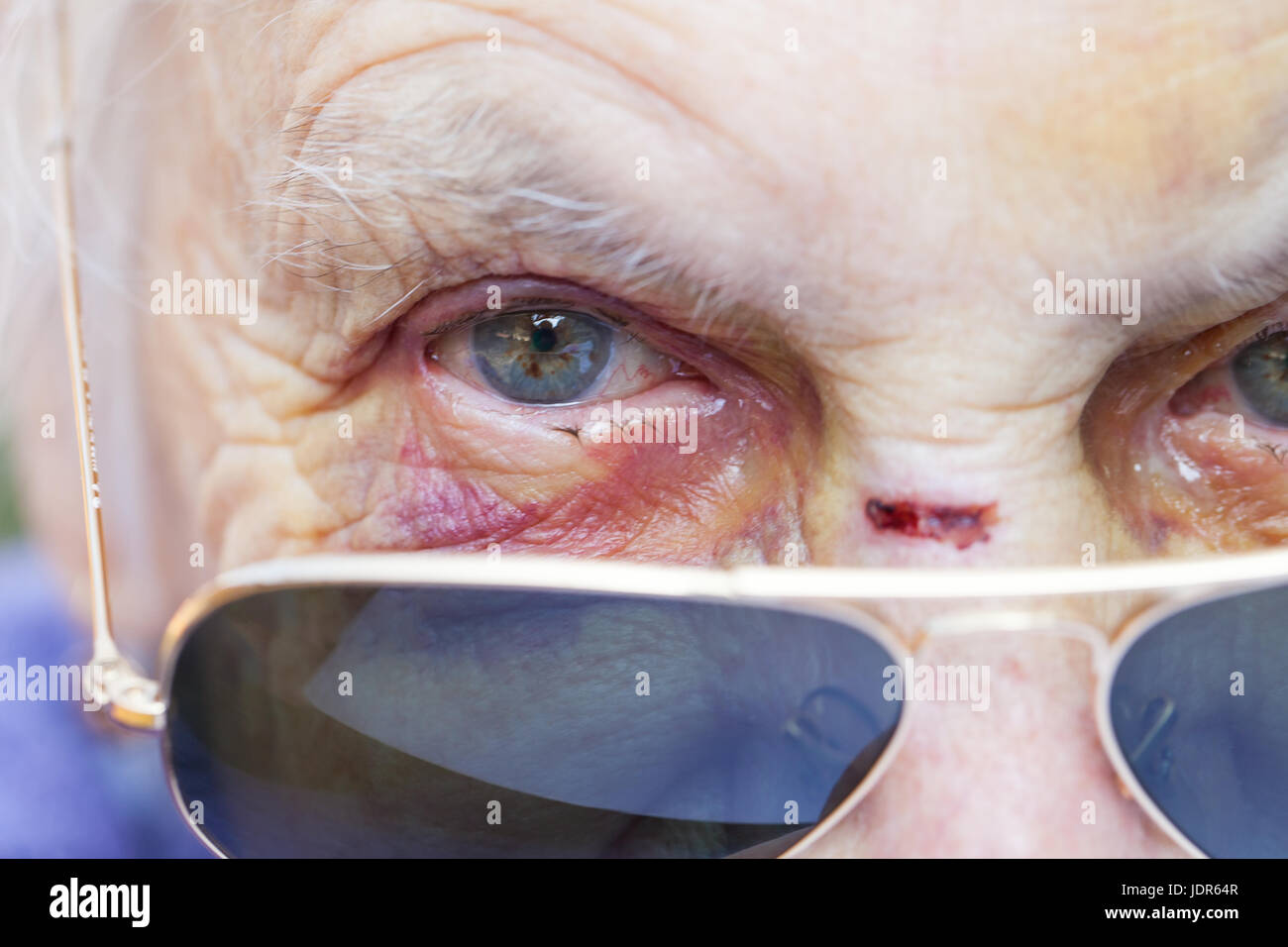 Close up picture of an injured elderly woman's eyes with sunglasses ...