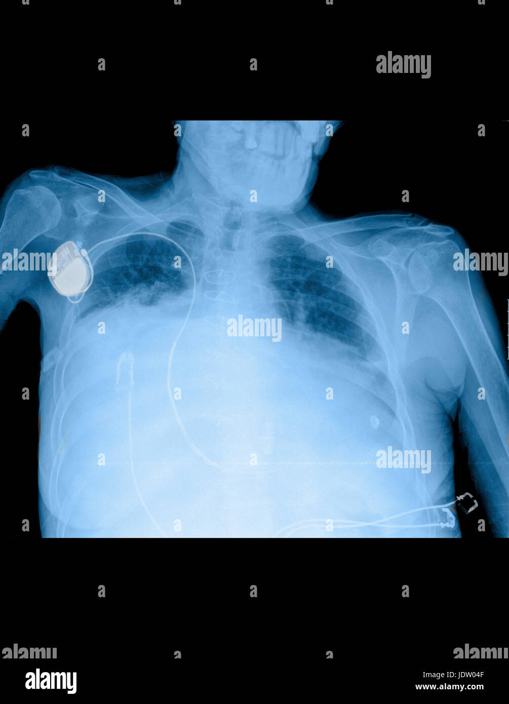 Dyspnea High Resolution Stock Photography and Images - Alamy