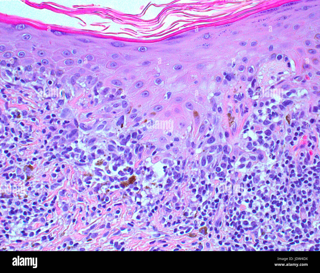 Malignant melanoma skin hi-res stock photography and images - Alamy
