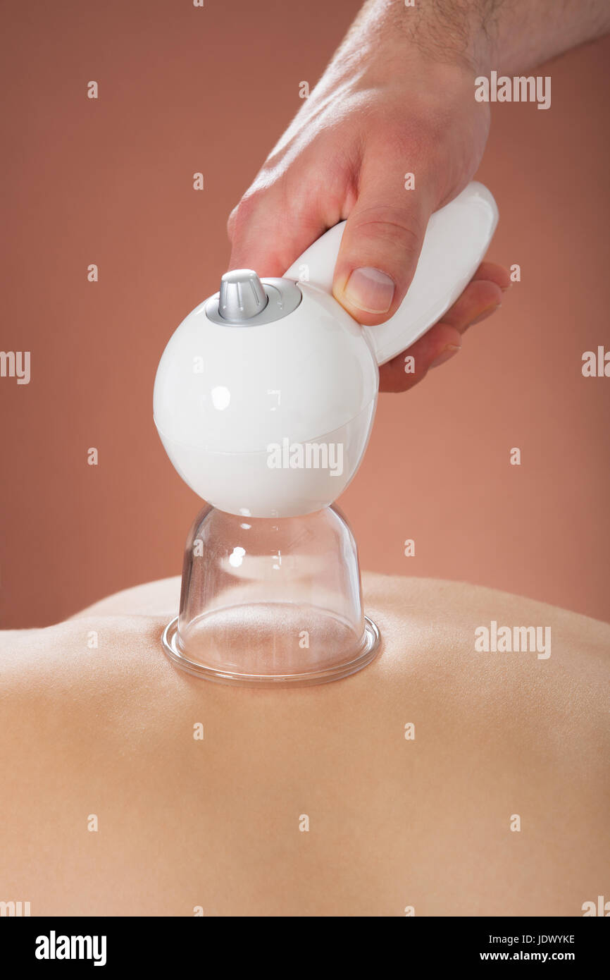 Cupping tool hi-res stock photography and images - Alamy