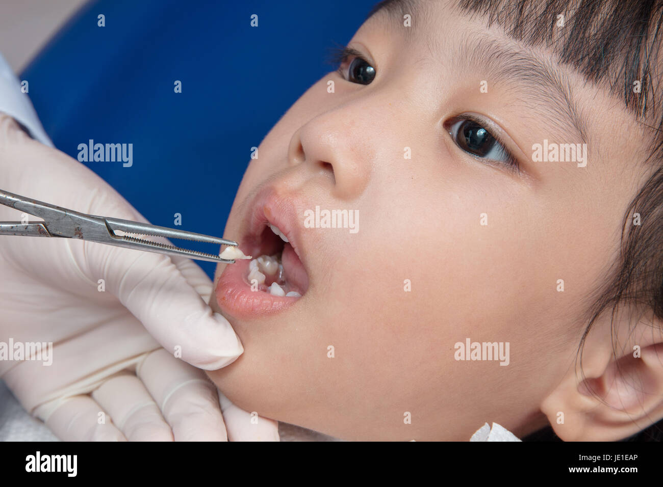 Asian Chinese little girl lying down for tooth extraction at dental ...