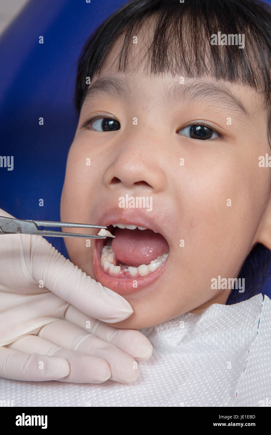 Asian Chinese little girl lying down for tooth extraction at dental ...