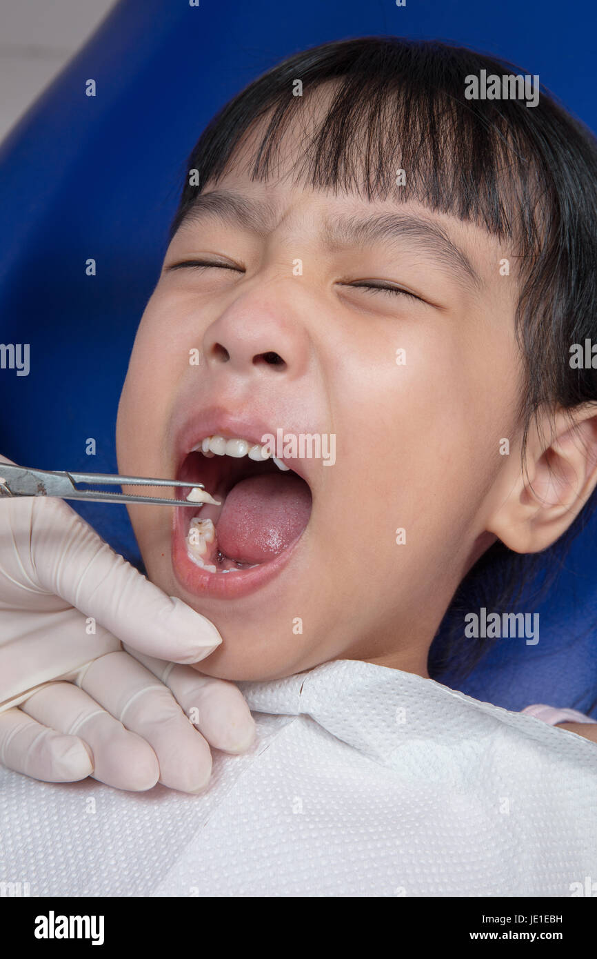 Asian Chinese little girl lying down for tooth extraction at dental ...