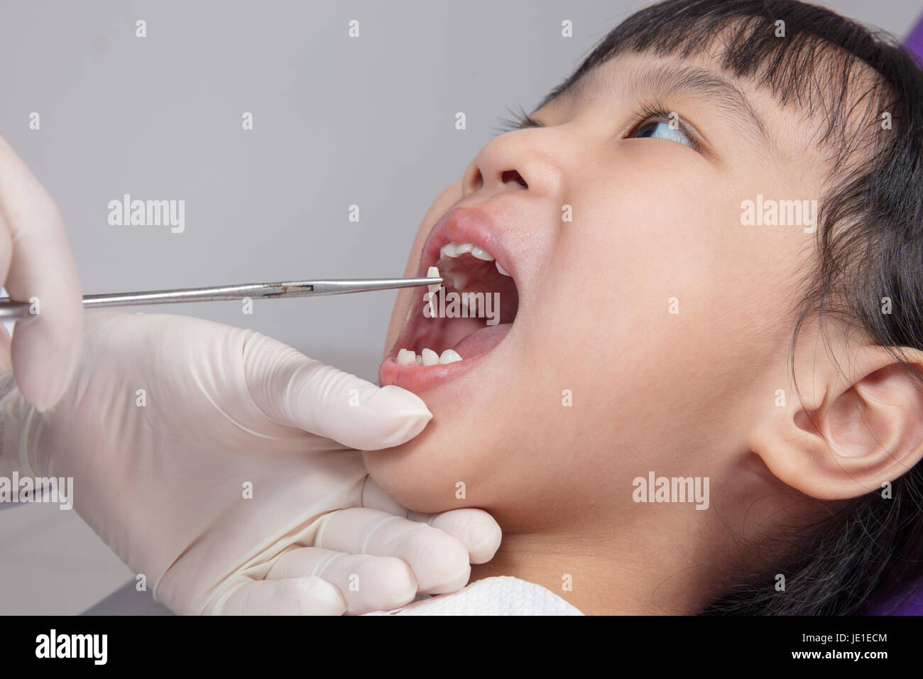 Asian Chinese little girl lying down for tooth extraction at dental ...