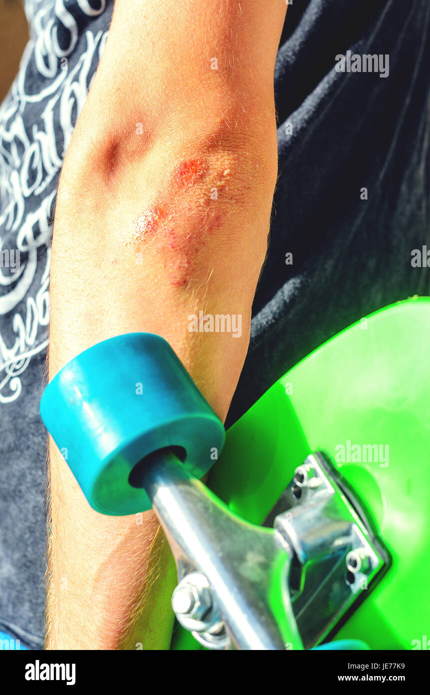 Skateboard Injuries High Resolution Stock Photography and Images - Alamy