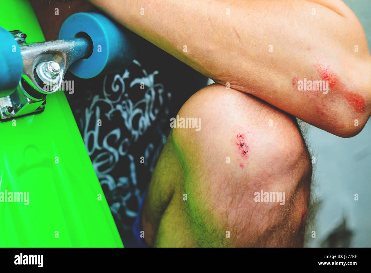 Skateboard injuries hi-res stock photography and images - Alamy