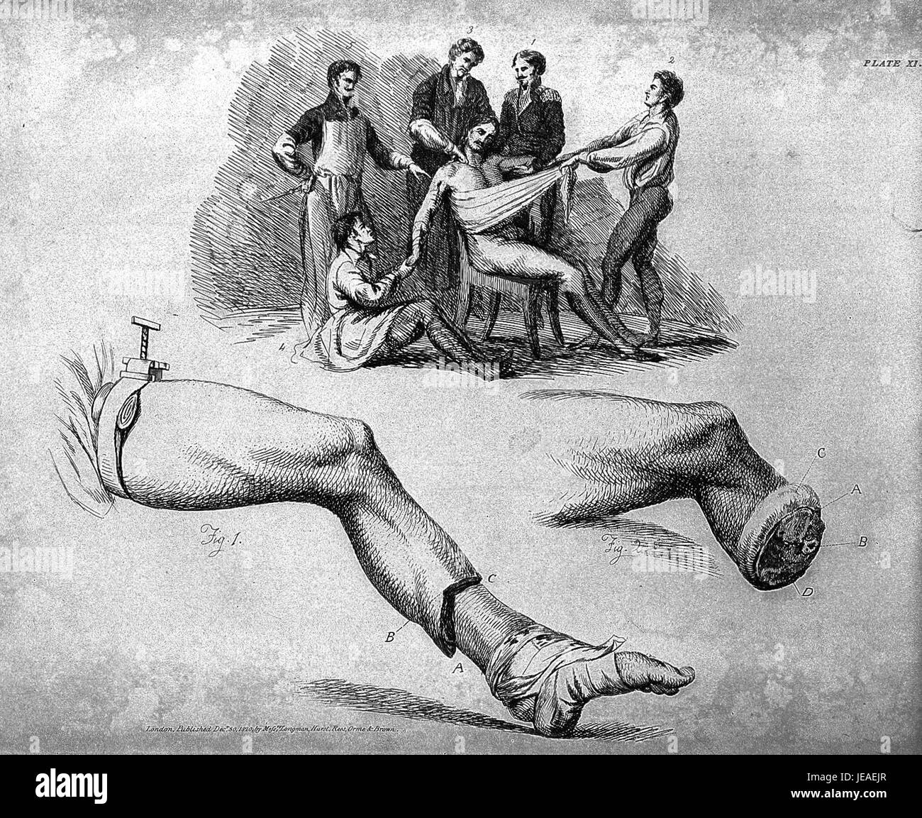 A medical illustration depicting the amputation of the shoulder joint ...