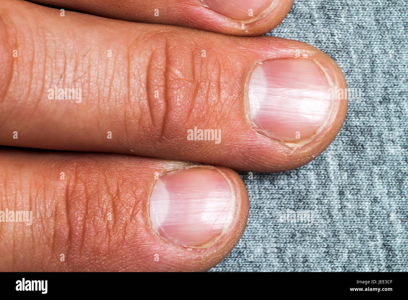 Chewed finger nails hi-res stock photography and images - Alamy
