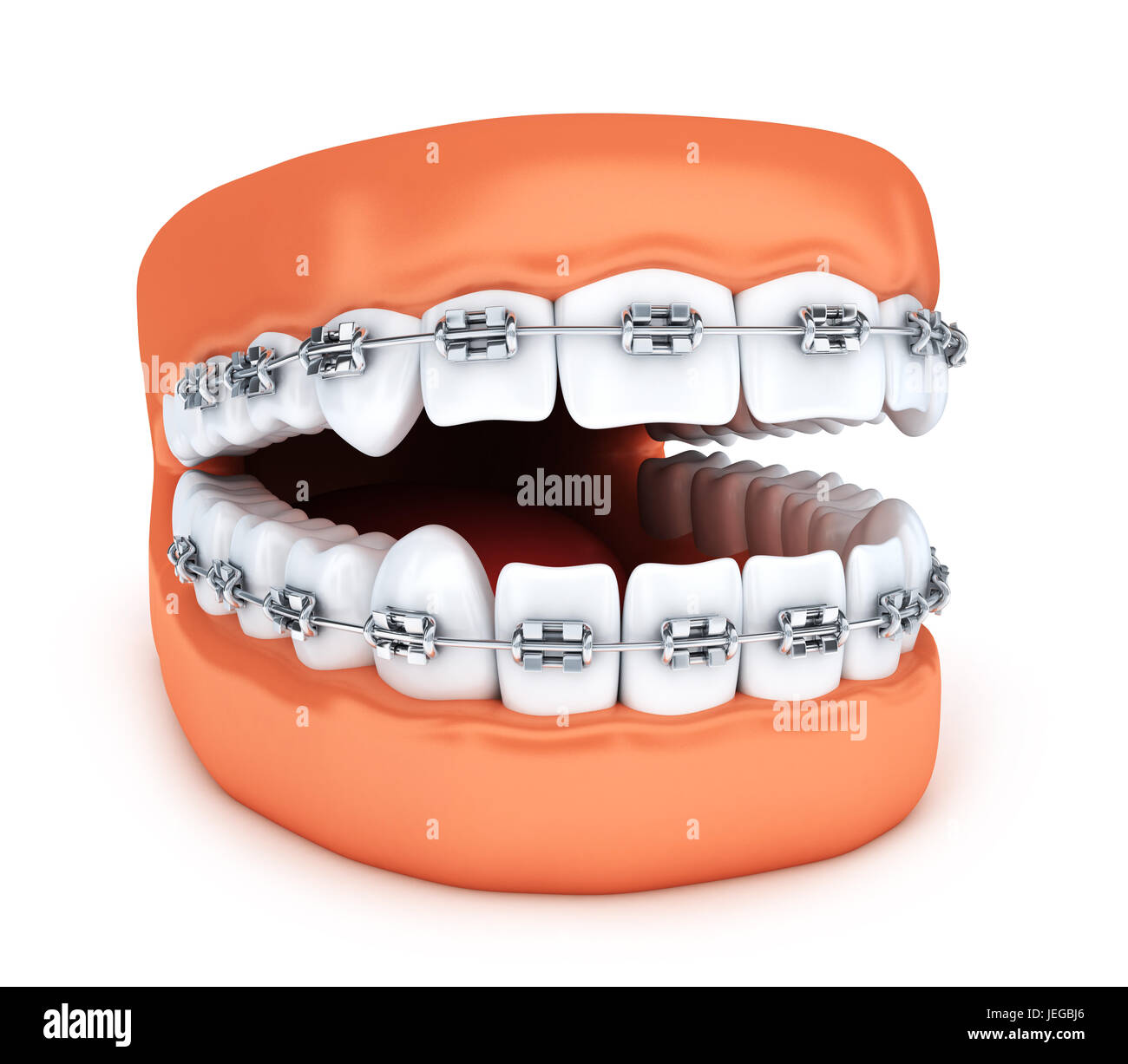 Orthodontic brackets Cut Out Stock Images & Pictures - Alamy