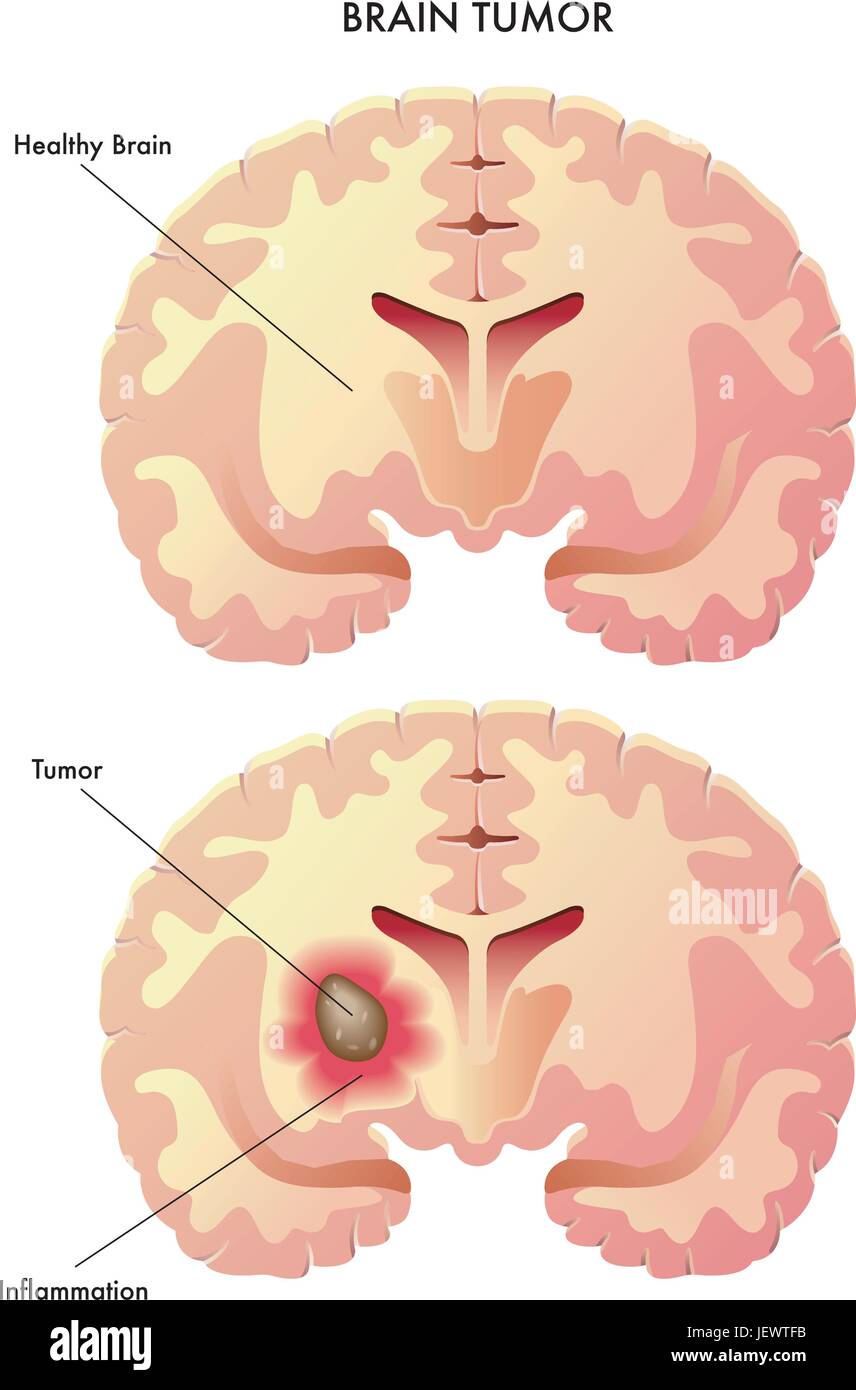 brain tumor cerebral lymphoma Stock Vector Image & Art - Alamy