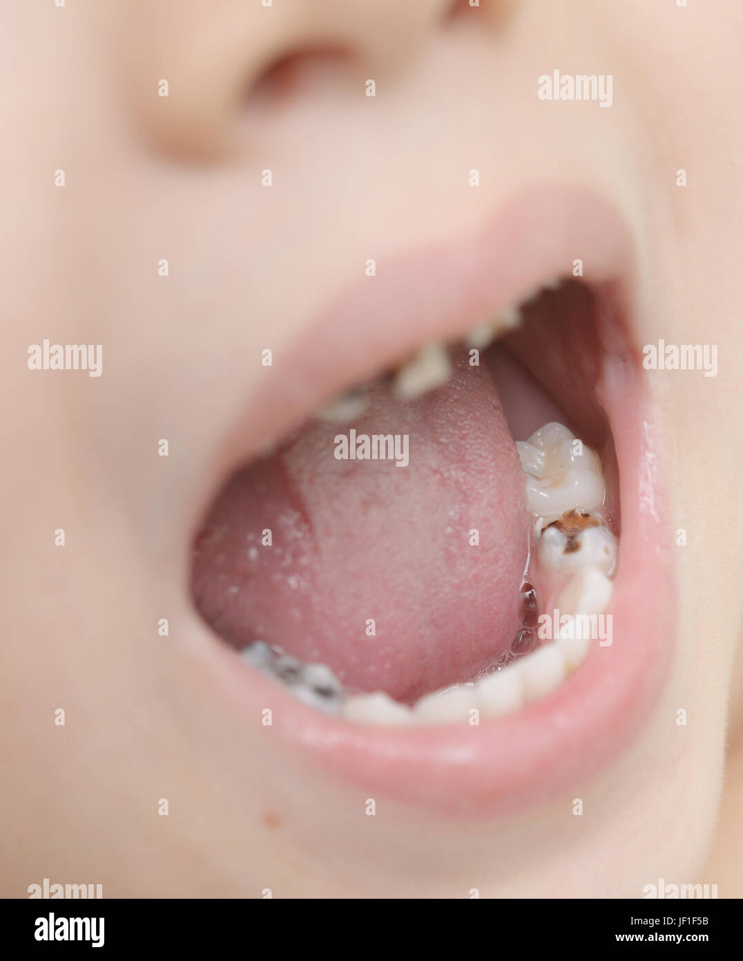 Rotten caries hi-res stock photography and images - Alamy