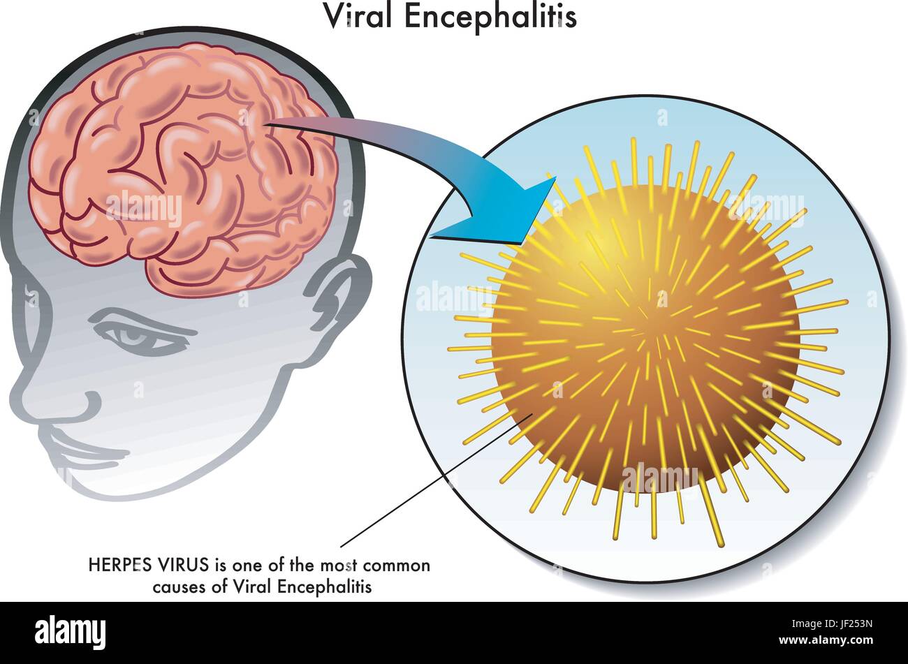 Viral encephalitis brain Stock Vector Images - Alamy