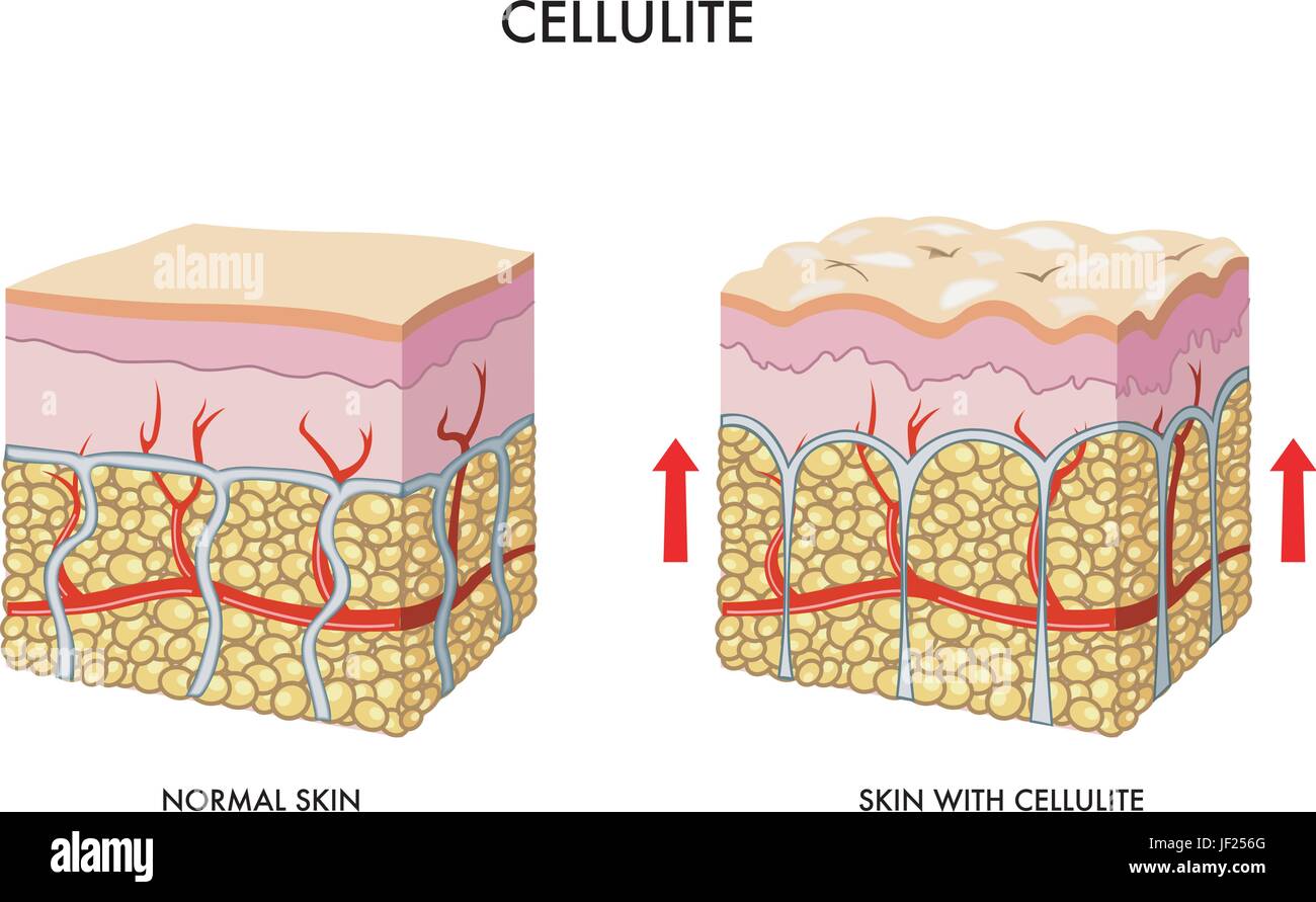 skin, thick, wide, fat, cellulite, skin, sclera, peel, metabolism ...