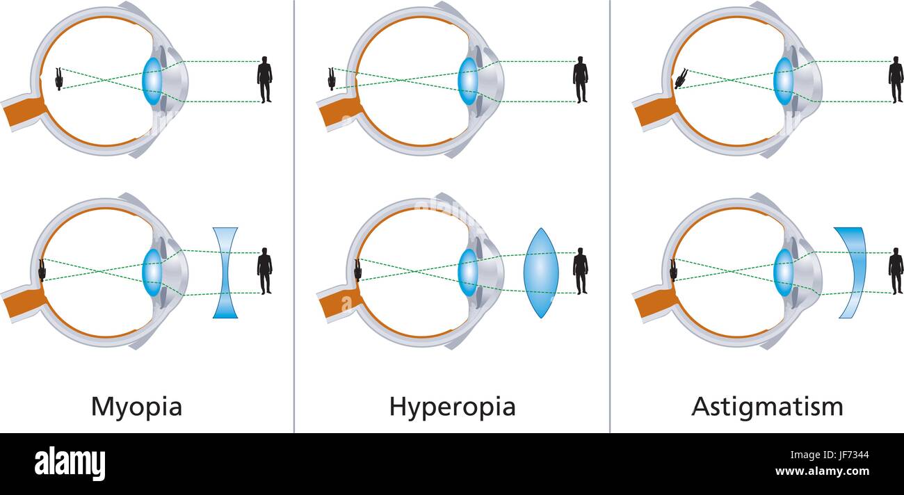 lenses, physics, optics, optional, eye, organ, human, human being ...