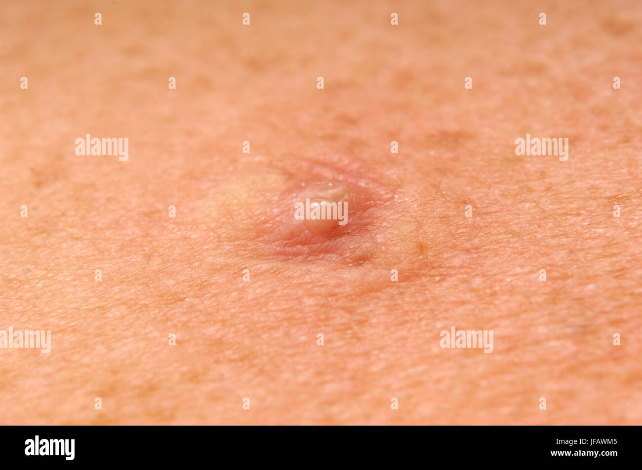 A pimple Stock Photo - Alamy