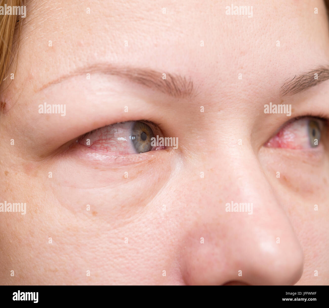 Girl sick red eyes hi-res stock photography and images - Alamy