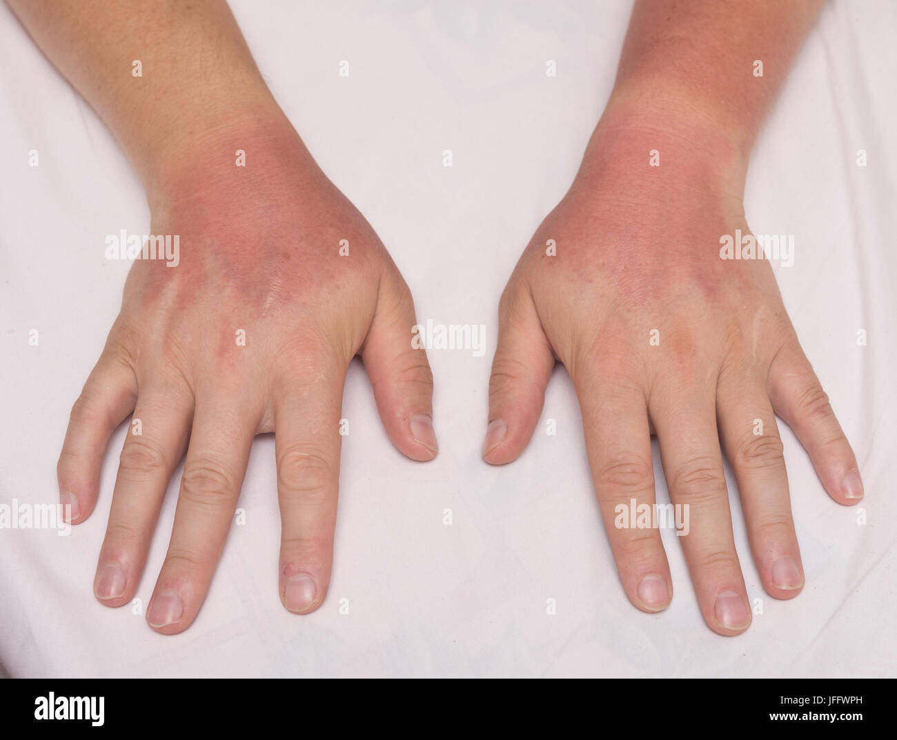 Sun damage arm hi-res stock photography and images - Alamy