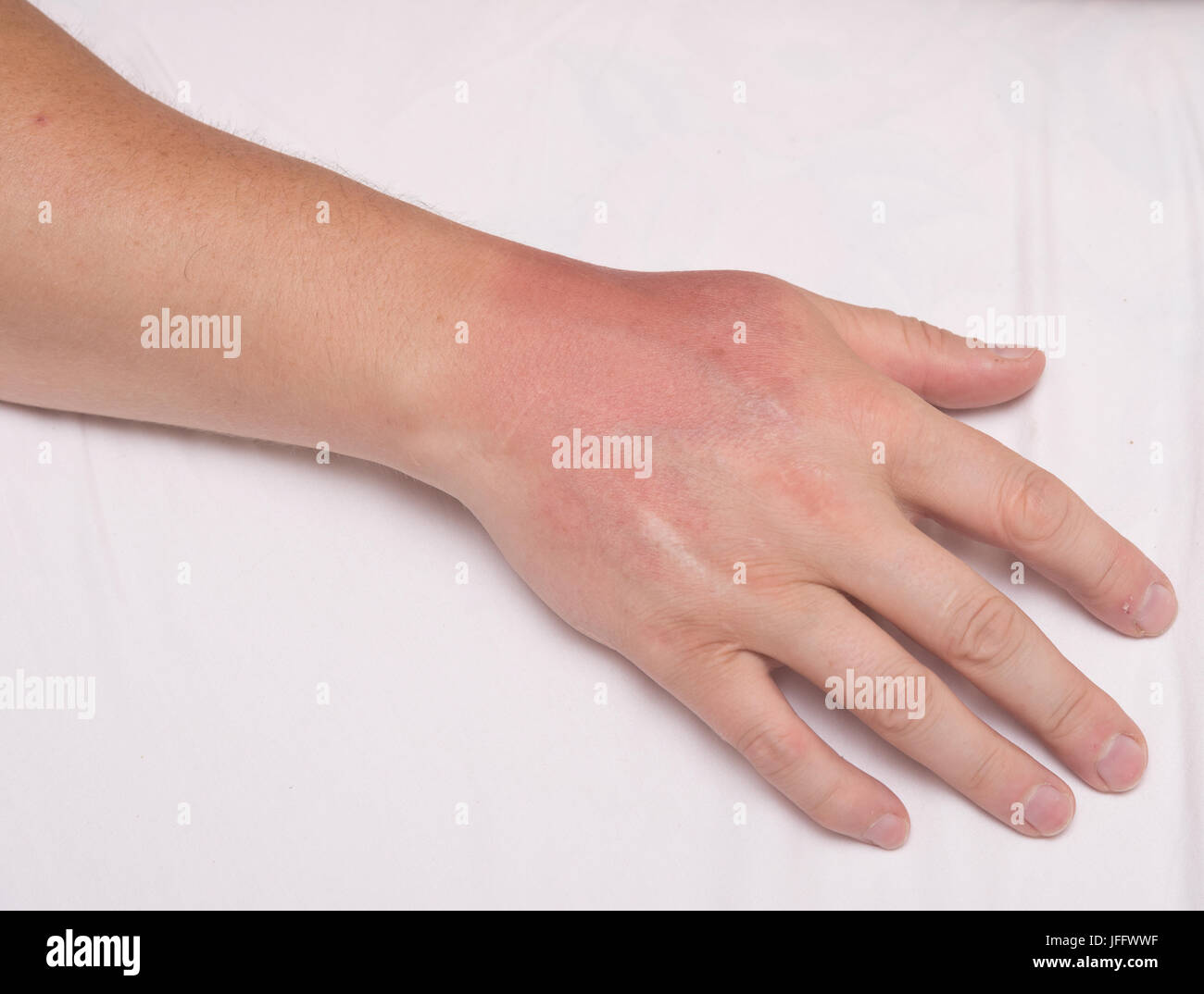 Sun damage arm hi-res stock photography and images - Alamy