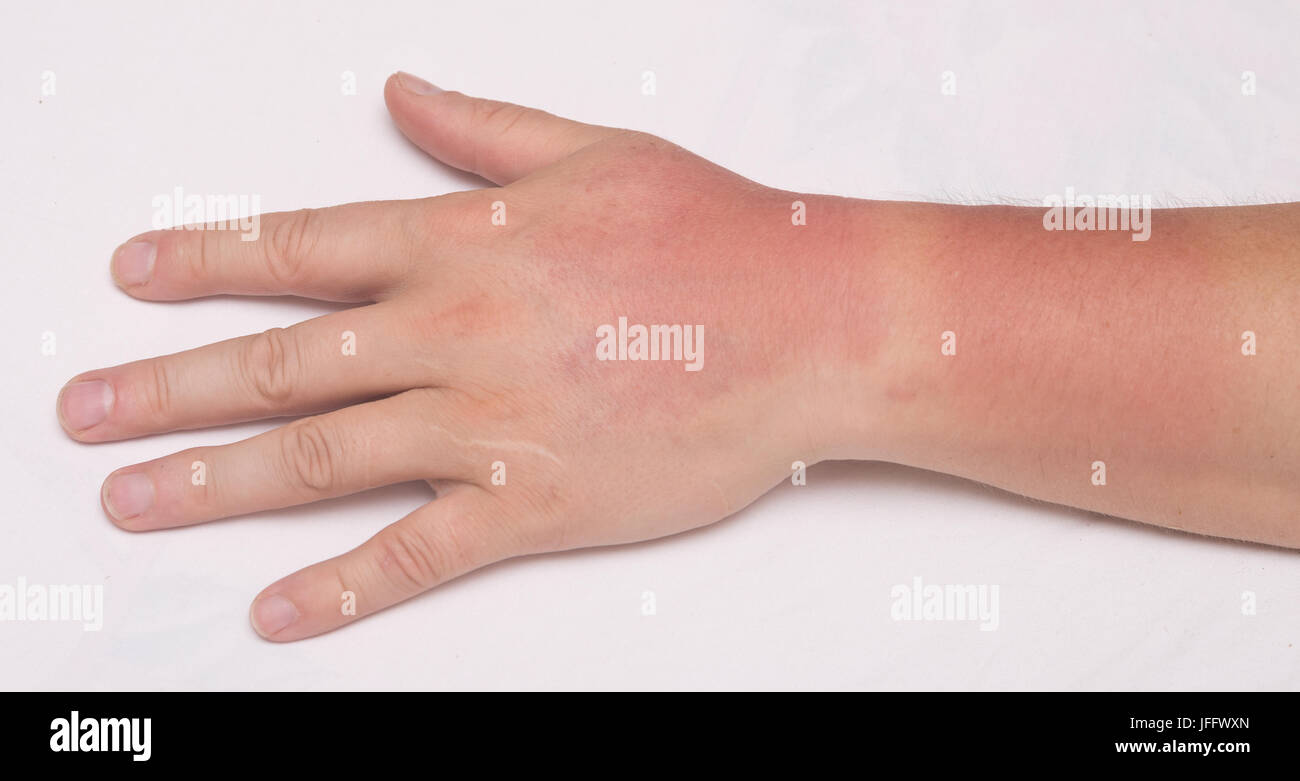 Person sun burn skin hi-res stock photography and images - Alamy