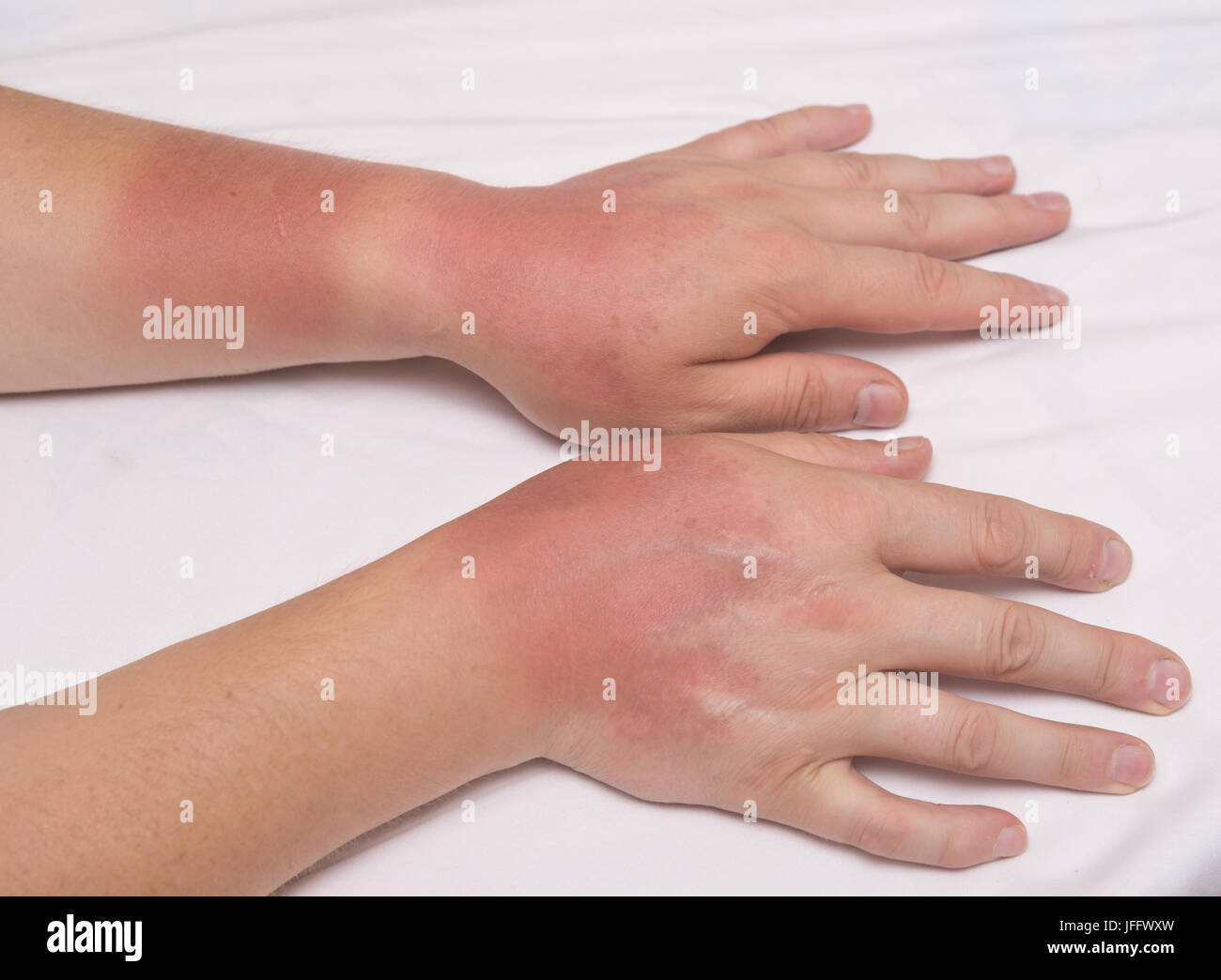 Sun damage arm hi-res stock photography and images - Alamy