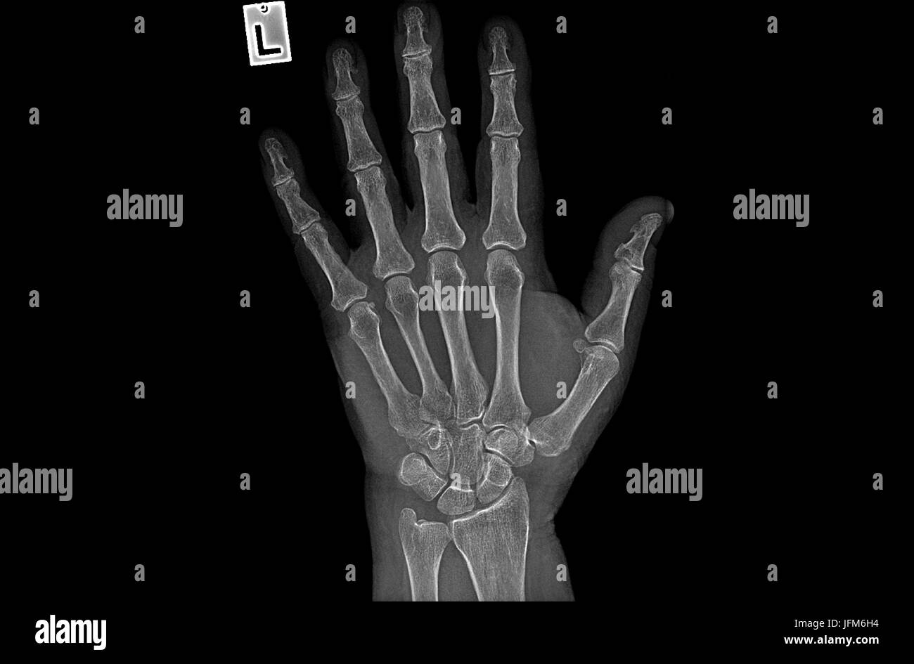 Negative X ray image of human hand Rheumatism Stock Photo - Alamy